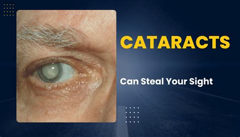 Can Cataracts Cause Low Vision