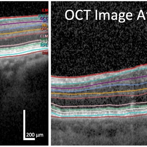 Representative Retinal Layer‐segmented Optical Coherence Tomography