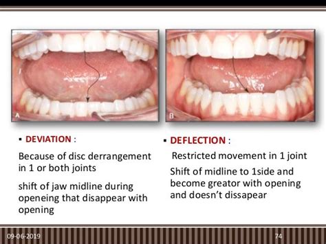 Tmj And Its Applied Aspects In Prosthodontics