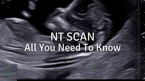Nt Scan All You Need To Know Sex Determination Possible Youtube