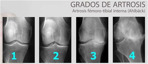 Tratamiento Artrosis Rodilla Valencia Gonartrosis Grados 1234