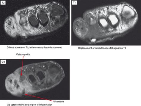 Infection Of The Musculoskeletal System Radiology Key
