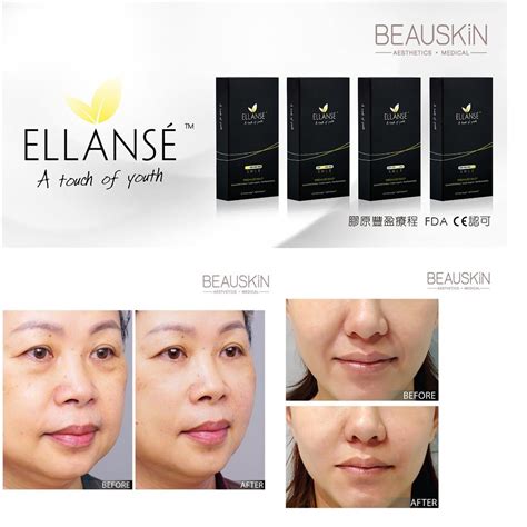Factory Outlet Ellanse M Pcl Dermal Filler Cmc Gel Carrier For Face