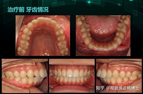 隐适美复杂病例（双颌前突，拔牙骨钉） 知乎