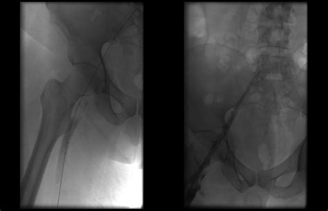 Left Left Lower Extremity Preintervention Venogram Right Left Lower Download Scientific