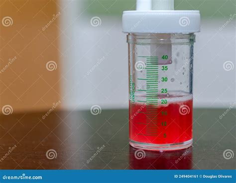 Sample Of Bronchial Lavage After Bronchoscopy Of A Patient Stock Image