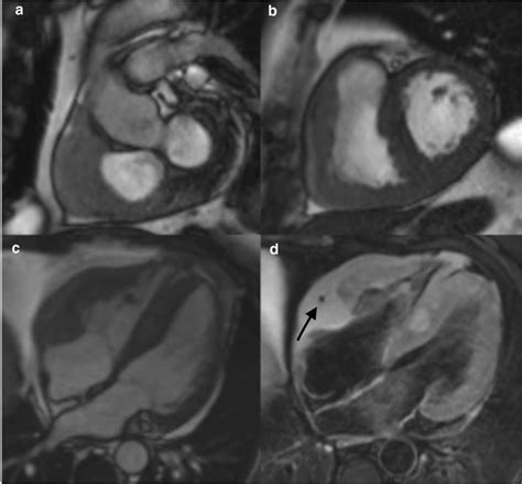 Primary Cardiac Lymphoma A Balanced Steady State Gradient Recall Echo Download Scientific