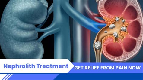 Nephrolith Should Not Be Neglected Heres Why Manisha Aries Tealfeed