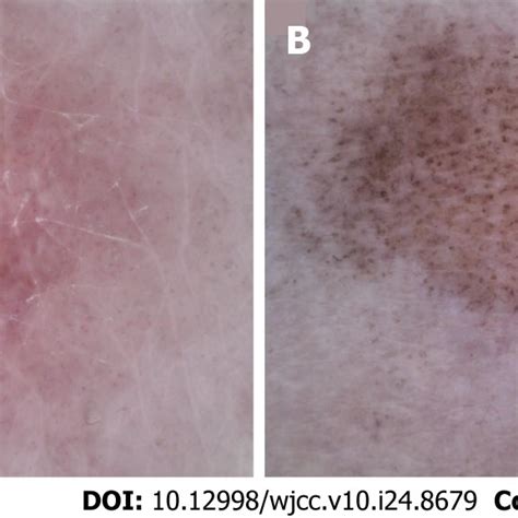 Dermoscopic Photographs 50× A Before Treatment Linear And