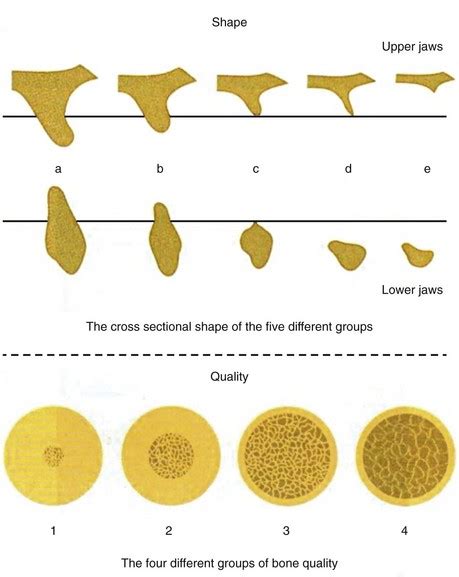 3 Factors Involved In Single Implants Pocket Dentistry