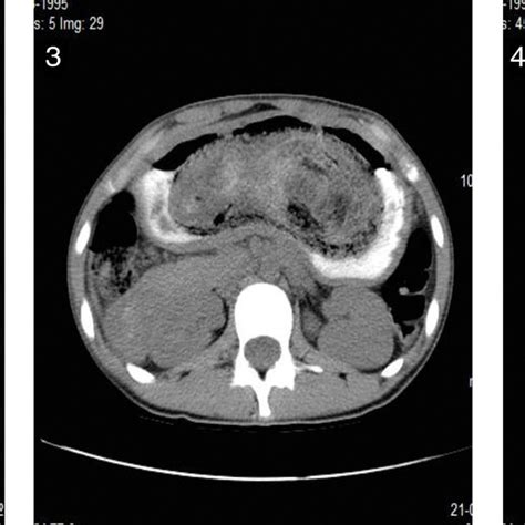 Confluent Dermatitis Artefacta Lesions On The Upper And Lower Limbs