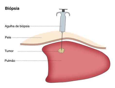 Procedimento De Biopsia Hepatica Técnica De Biópsia Hepática Guiada