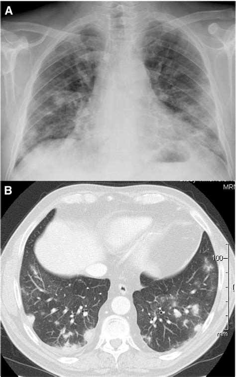 A Chest X Ray Multiple Bilateral Nodular Opacities B Thoracic Download Scientific Diagram