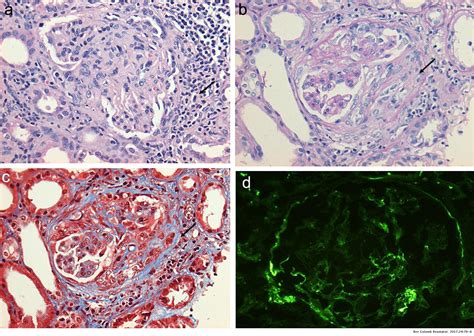 Clinical And Pathological Characteristics Of Pauci Immune Renal