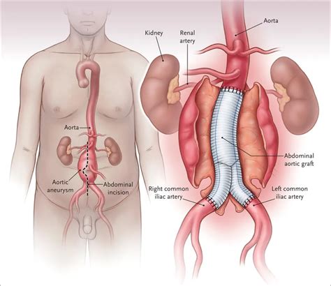 Abdominal Aortic Aneurysm Aaa Cause Symptom Treatment