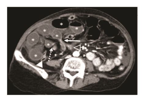 Contrast Enhanced Ct Of The Abdomen And Pelvis Demonstrating Closed