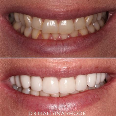 Veneers London Drmr By Dr Manrina Rhode