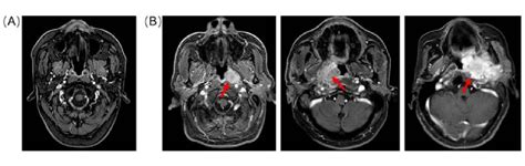 Figure 1 From Deep Convolutional Neural Network For Nasopharyngeal Carcinoma Discrimination On