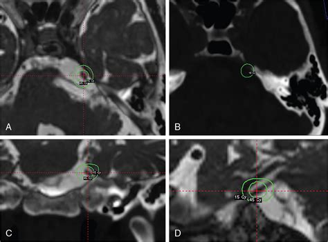 Trigeminal Neuralgia Due To Microvascular Conflict Upfront Radiosurgery Radiology Key