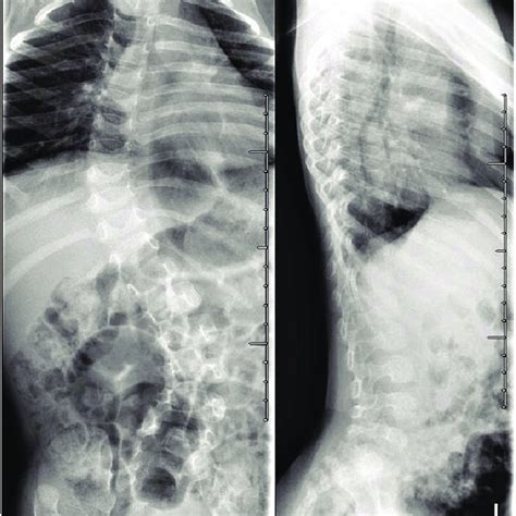 Radiographs Of The Girl Taken At Two Years Of Age Showing Bilateral Hip