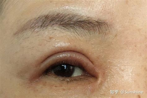 想请教下眼部肿起来了该用点什么药好 知乎
