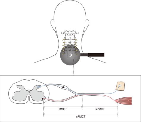 Schematic Diagram Illustrating The Measurement Of C8t1 Root Motor
