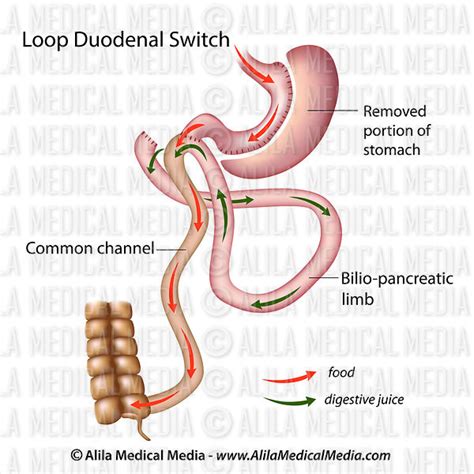 Alila Medical Media Loop Duodenal Switch Medical Illustration