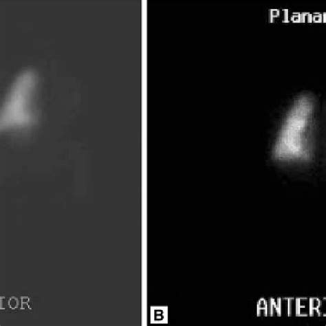 A Lung Perfusion Scan On Day 3 Of Life Showing Less Than 10 Perfusion Download Scientific