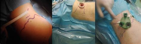 Retroperitoneoscopic Single Site 3d Adrenalectomy For Left Adrenal Renal Cell Carcinoma