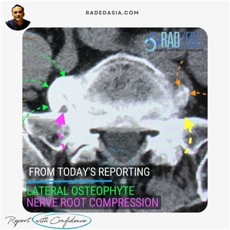 Ct Lumbar Lateral Osteophyte Causing Nerve Compression Radiology