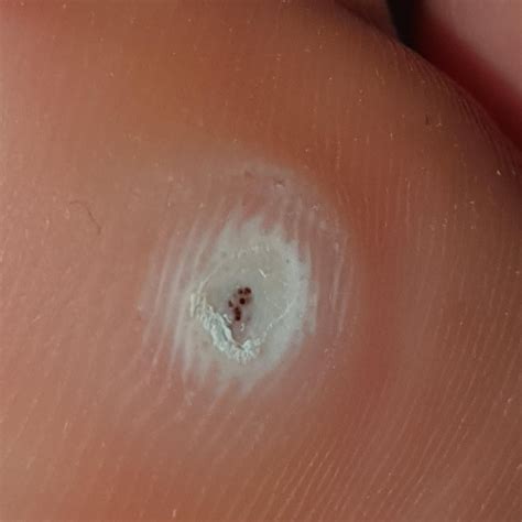 How Do I Know When A Verucca Is Dying Rwarts