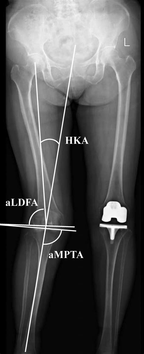 In The Malalignment Test Mat The Hip‐knee‐ankle Angle Hka The Download Scientific Diagram