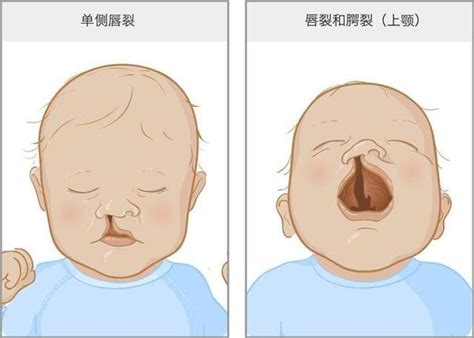 宝宝为什么会长兔唇？不想生兔唇宝宝，这5件事能避则避 知乎