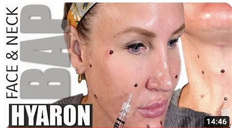 Face And Neck Bap Technique Hyaron Facial Rejuvenation