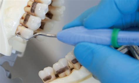 Effective Instrumentation With Gracey Curettes Lm Dental