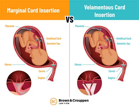 Marginal Cord Insertion Causes Risks Treatment Brown And Crouppen Online Lesson