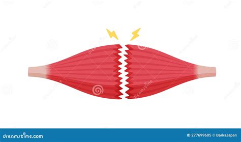 Muscle Rupture Vector Illustration Complete Tear Stock Vector