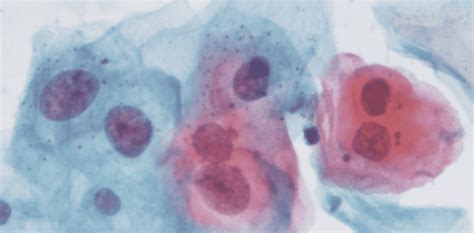 Le Papillomavirus Tabou Qui Porte En Lui Des Angoisses De Maladie Et