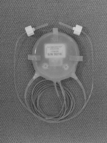 Implantable Telemetry Unit Fitted With 2 Fluid Filled Catheters For