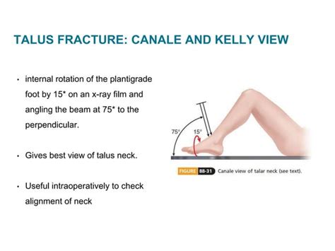 Talus Fracture Treatment Algorithm Ppt