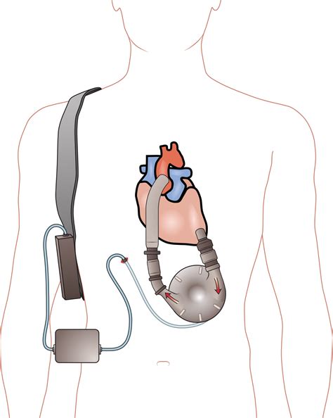 Tandem Heart What Is It And When Do You Need It