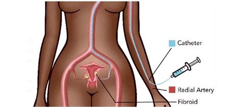 Uterine Fibroid Embolization Genesis Hospital Treatment