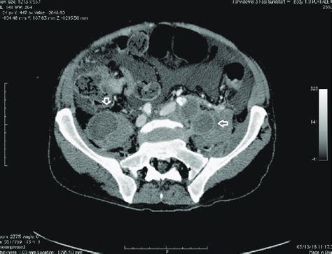 Mdct Angiography Axial Image Shows Also The Presence Of Abscesses Of