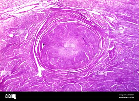 Uterine Fibroid Light Micrograph Of A Section Through Tissue From The