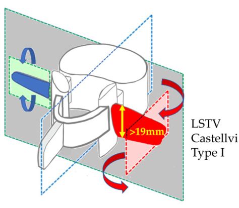 Castellvi Classification Castellvi Klassifikation Xcpm