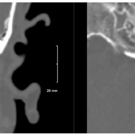 Coronal Left And Axial Right Images From CT Temporal Bone Without Download Scientific