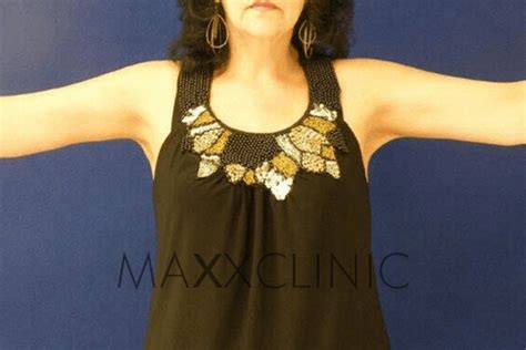 Maxxclinic Arm Lift Brachioplasty Good Better Maxx