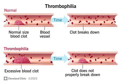 Types Of Clotting Disorders