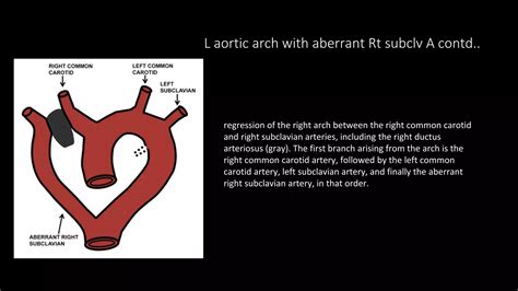 Aortic Arch Anomalies 2 Pptx