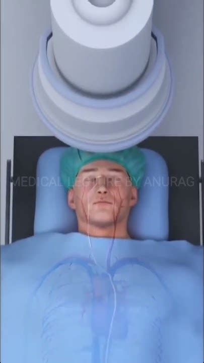 Neuro Embolization Cerebral Aneurysm 3dmedicalanimation Shorts